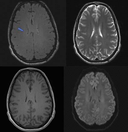 Developing a multivariate model for the prediction of concussion ...