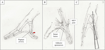 Tendon and ligament injuries of the finger and thumb in athletes: a ...